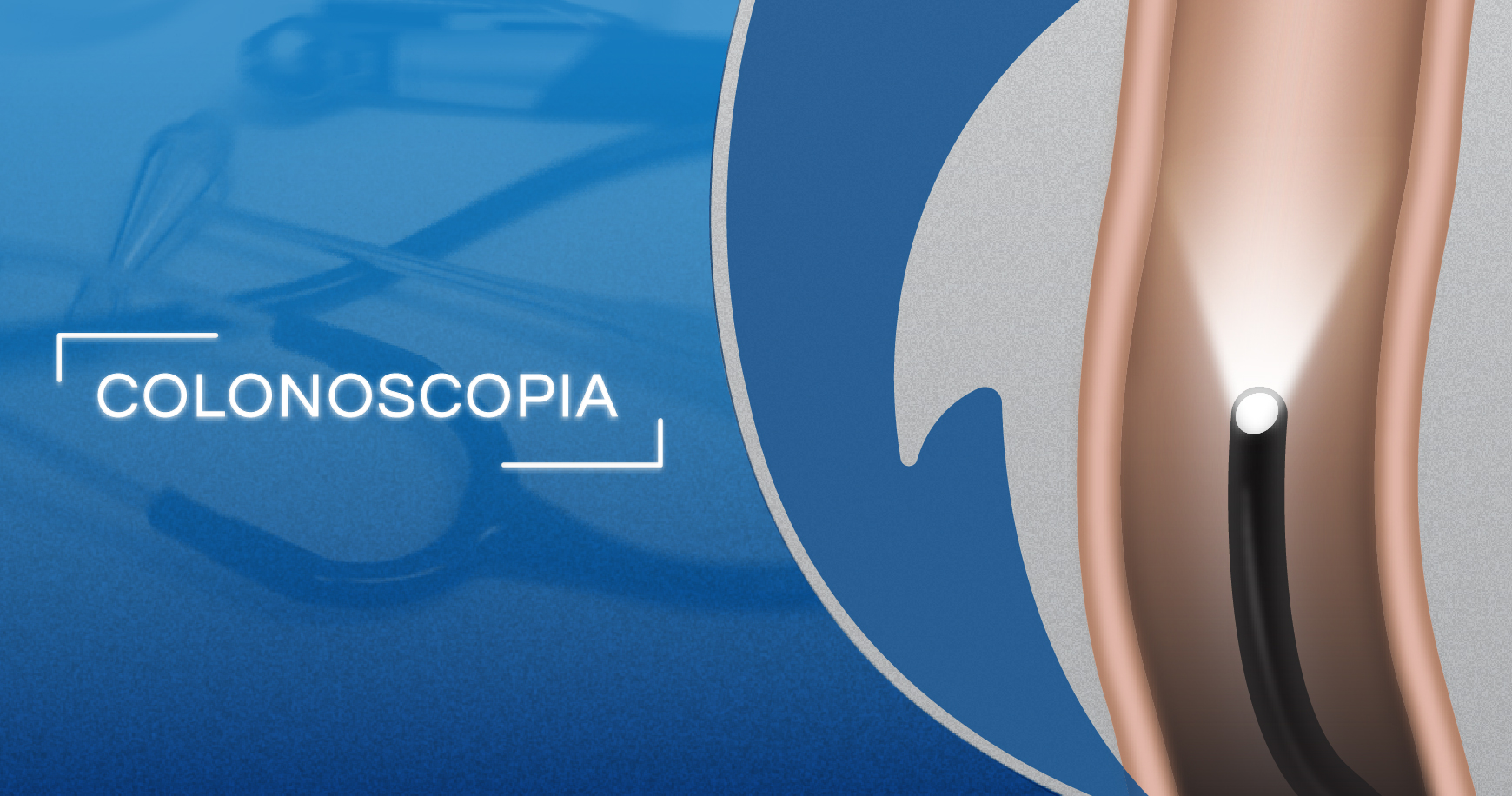 Colonoscopía: un estudio preventivo - TVSana